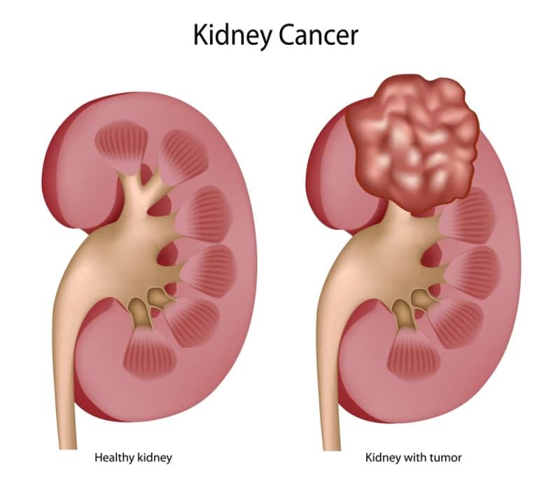 Diagnosis Of Kidney Cancer Kidney Cancer Specialists In Nyc