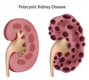 Kidney Cysts - Kidney Cancer Specialists in NYC