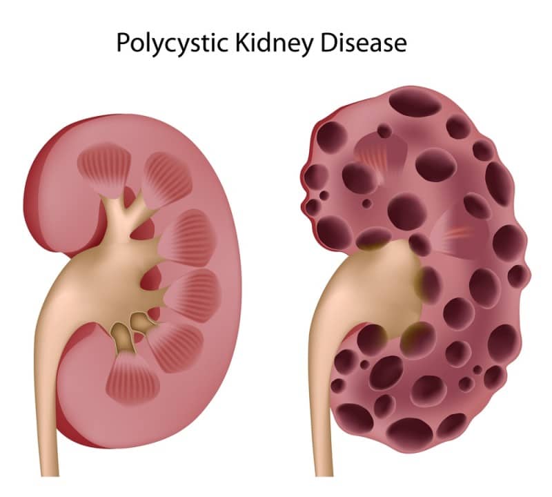 Kidney Cysts - Kidney Cancer Specialists in NYC