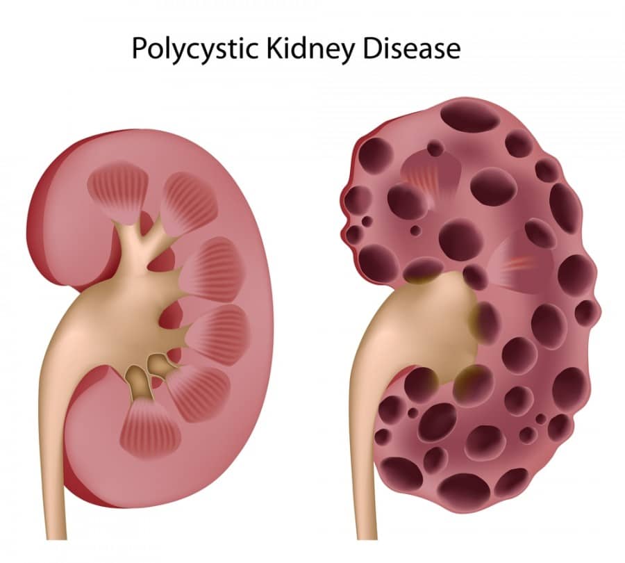 Kidney Cysts - Kidney Cancer Specialists in NYC