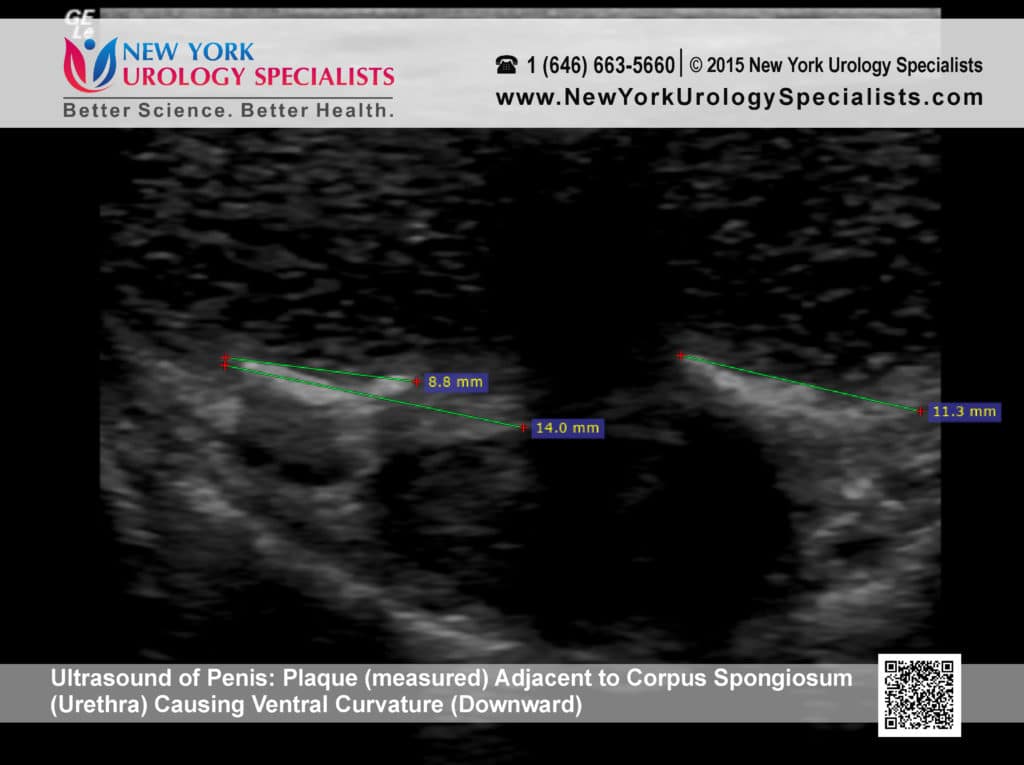 Peyronie's Disease Picture Gallery: Images of Peyronie's Disease - NYC ...